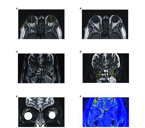 mri measurements in go a c length parameters such as proptosis
