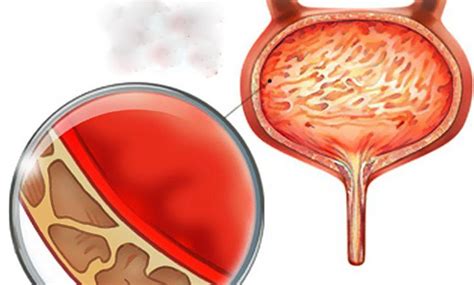 ეფექტური ხალხური რეცეპტები ცისტიტის სამკურნალოდ სასარგებლო რჩევები