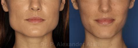 Patient 147123766 Tmj Masseter Botox Gallery Before And After Photos