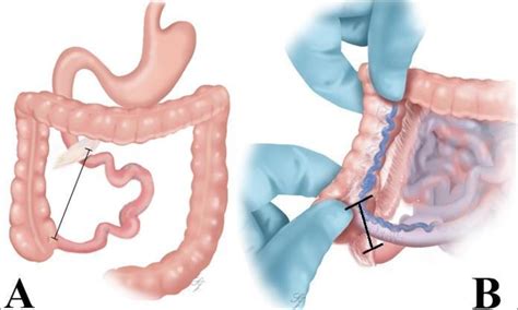 Mesenteric Root In Normal Isolated Duodenal Nonrotation Re Drawing