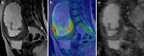 Cellular Leiomyoma With Cystic Degeneration In A 49 Year Old Woman