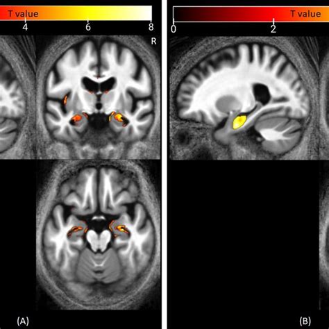 Statistical Parametric Maps Of The Univariate Analysis For Ad And Hc Download Scientific