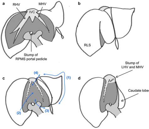 Left Hepatectomy After Right Paramedian Sectoriectomy Springerlink