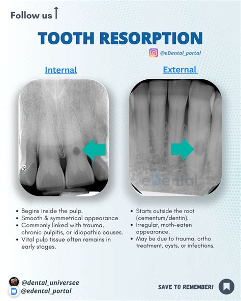 External Resorption Vs Internal Resorption