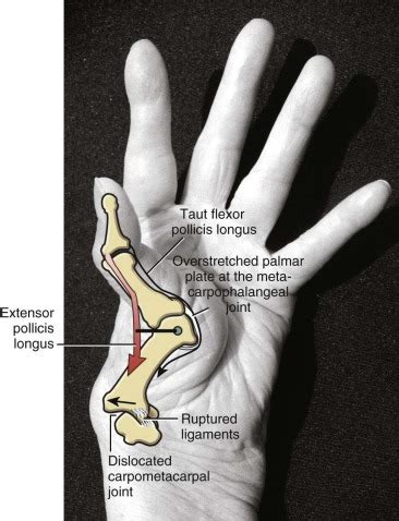 Therapists Management Of The Thumb Carpometacarpal Joint With