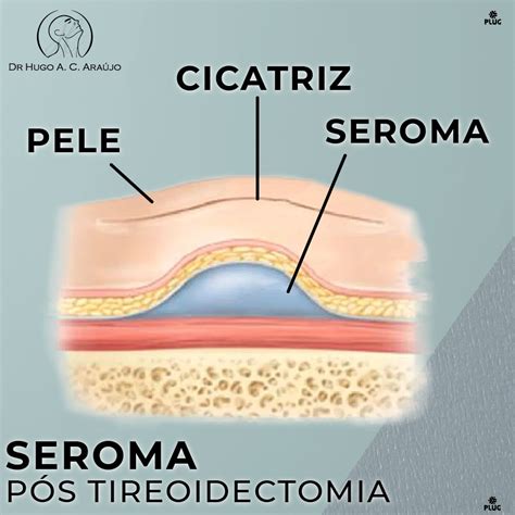 Seroma Pós Tireoidectomia