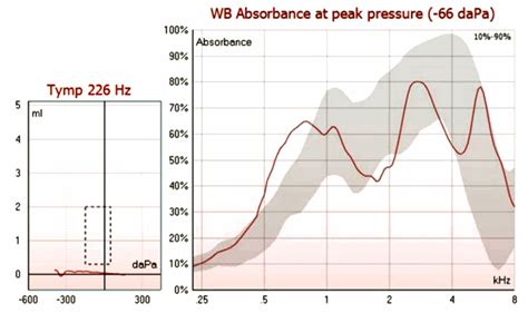Multifrequency Tympanometry Ent And Audiology News