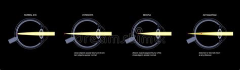 Hyperopia Astigmatism Stock Illustrations 706 Hyperopia Astigmatism Stock Illustrations