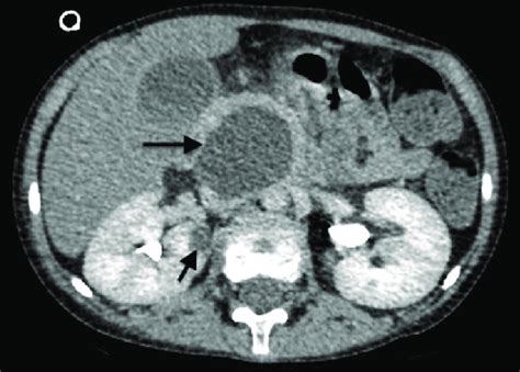 Ct Abdomen Contrast Hypodense Lesion In The Uncinate Process Of The