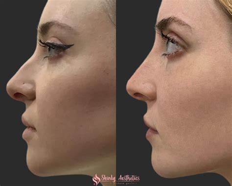Contouring Nose Before And After