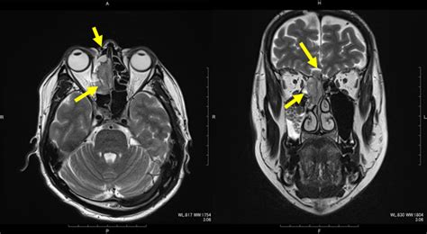 Mri Findings Left Ethmoid Sinus Tumor Seen Attached To The Right