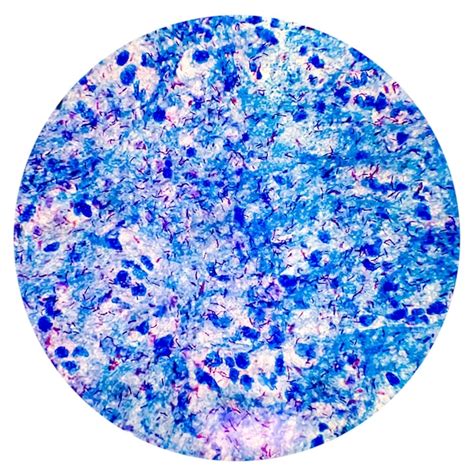 Premium Photo Sputum Smear Afb Stain Microscopic Show Microbacterium Tuberculosis Tb Mtb