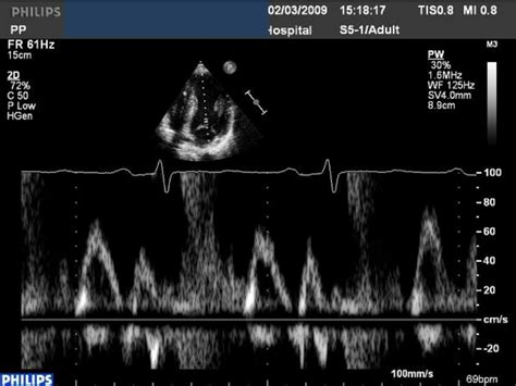 Normal Indices Of Diastolic Function Mitral Inflow Ea Ratio Of 1 Download Scientific Diagram