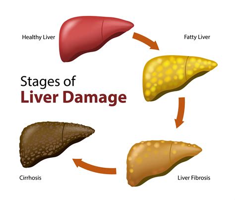 Final Stage Cirrhosis Of The Liver Symptoms Fatty Liver