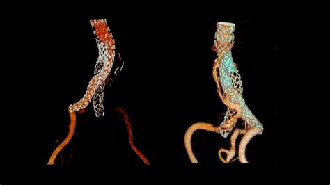 Endoleak And Stent Graft Occlusion After Endovascular Aneurysm Repair