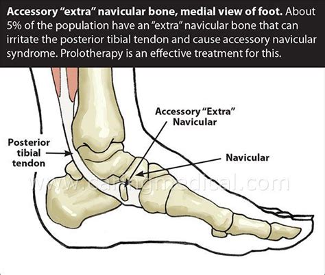 Surgery Remove Accessory Navicular Bone At Jimmy Lewis Blog