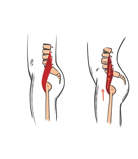 Anterior Pelvic Tilt Causes Symptoms And The Best Physiotherapy