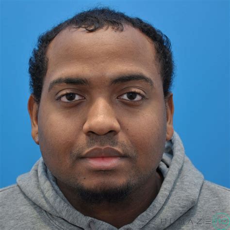 Keloid Scar Removal Case 11064 Beaty Facial Plastic Surgery