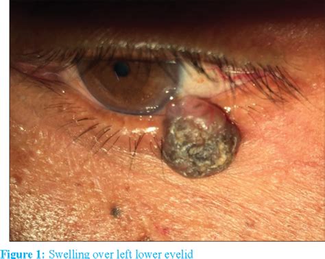 Figure 1 From High Dose Rate Surface Mold Brachytherapy In A Case Of