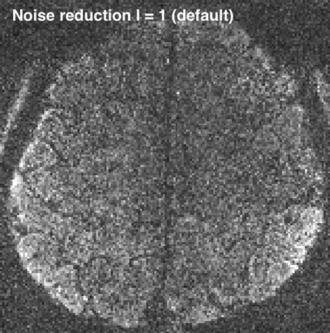 Grappa Regularization Layer Fmri Blog