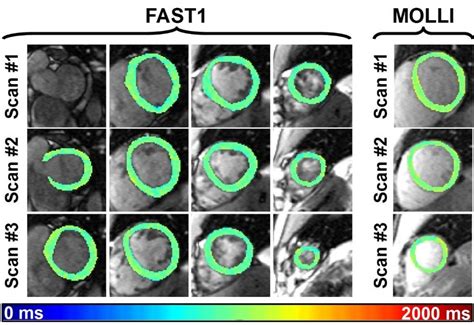 Towards Widespread Use Of Cardiac Mri Using New Affordable Low Magnetic Field 0 55t Mri