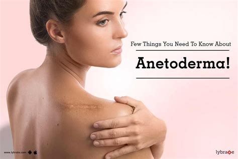 Few Things You Need To Know About Anetoderma By Dr Rupa Shah Lybrate Few Things You Need To Know About Anetoderma By Dr Rupa Shah Lybrate
