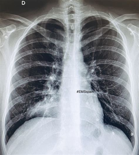 Ems Spain Neumonía Basal Derecha Neumologia Neumonia