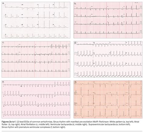 Cardiac Tachyarrhythmias A Primary Care Approach Medicine Today