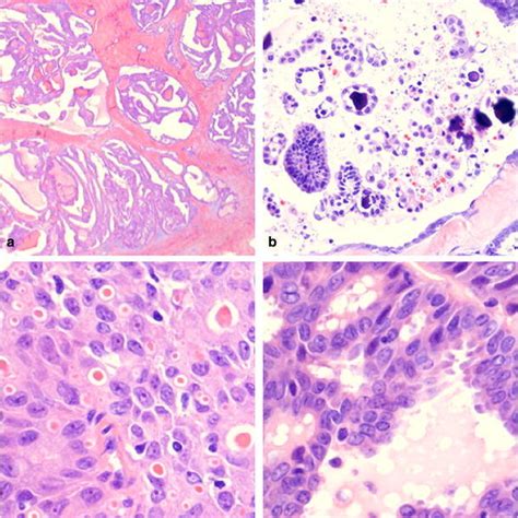 Axial Ct Scan Image Of The Patients Large Thyroid Mass Prior To