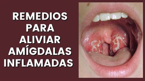 Que Es Bueno Para Las Amigdalas Inflamadas En Adultos ⌚ Cuanto Tiempo