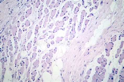 skeletal muscle atrophy photomicrograph showing decreased fiber size