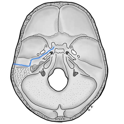 Temporal Bone Fracture Case Report • New Medicine 3 2022 • Czytelnia Medyczna Borgis