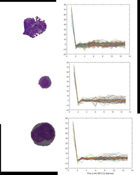 mfccs of different leukemia images download scientific diagram