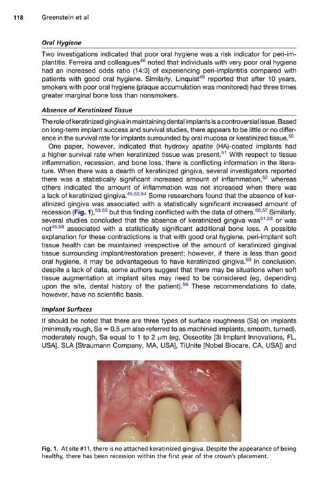 Dcna Dental Mplants In Periodontal Pt Pdf Oral Care Personal Care