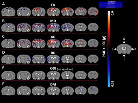 Voxel Wise Statistical Maps Using DTI And NODDI Derived Parametric Download Scientific Diagram