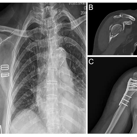 An Example Case Of A Right Proximal Humerus Fracture In A 54 Year Old Download Scientific