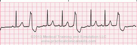 Premature Ventricular Contractions Pvc Boss Rn