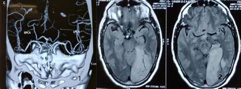 Patient A 1 Left Pca P2 Segment Attenuation 2 Left Pca Infarct