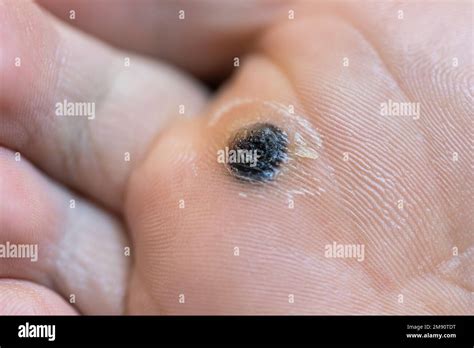 Closeup Of Wart Plantar After Cauterizing It With Celandine On Infected