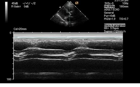 M Mode Flashcards Quizlet