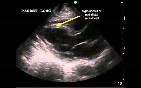 Apical Ischemia Youtube
