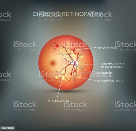 Latar Belakang Retinopati Diabetes Ilustrasi Stok Unduh Gambar