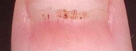 Nail Fold Capillaries Pdf Nailfold Capillaroscopy In Rheumatic