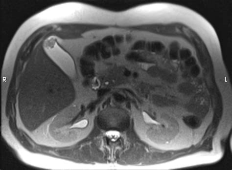 Radiopaedia Case Gallbladder Polyp Id Study Nc Commons