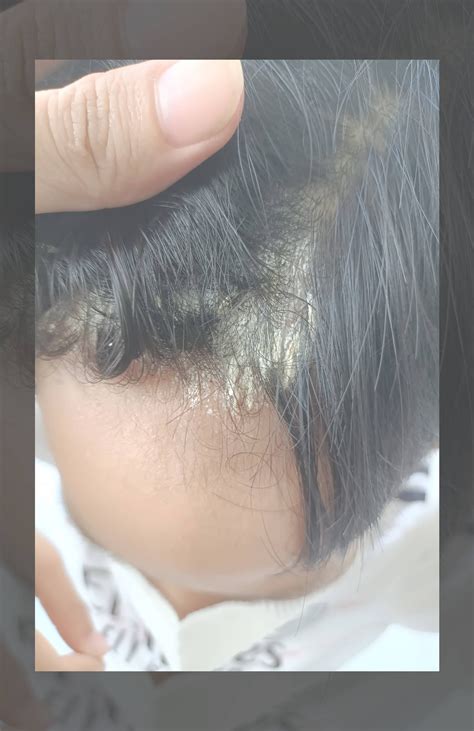 Babala Mula Lang Sa Balakubak Ang Normal Na Pangangati Ay Humahantong Sa Fun Gus Ng Anit Na