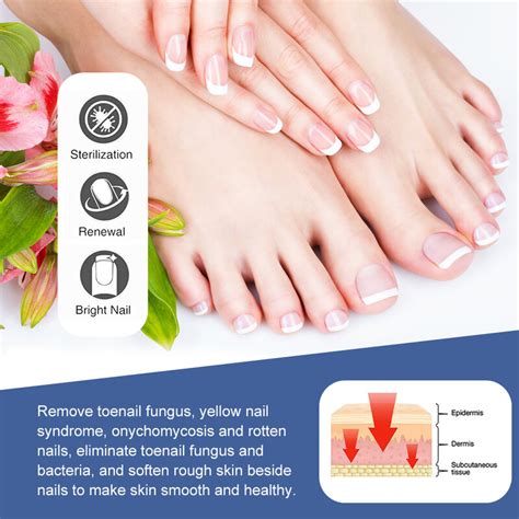 10ml Sumifun Nail Fungus Liquid Treat Onychomycosis Paronychia