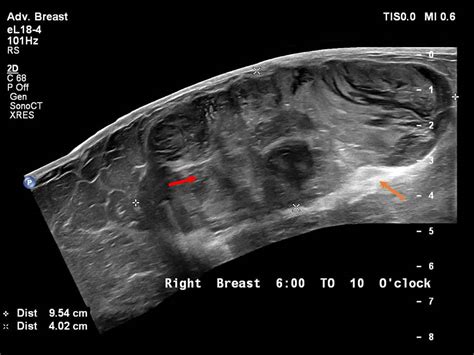 Atlas Of Breast Cancer Early Detection