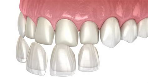 Veneer Installation Procedure Over Central Incisor Backgrounds