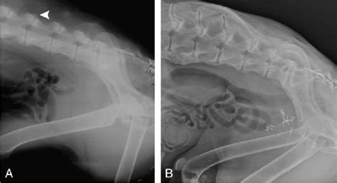 Figure 1 From Bilateral Iliopsoas Muscle Contracture And Spinous