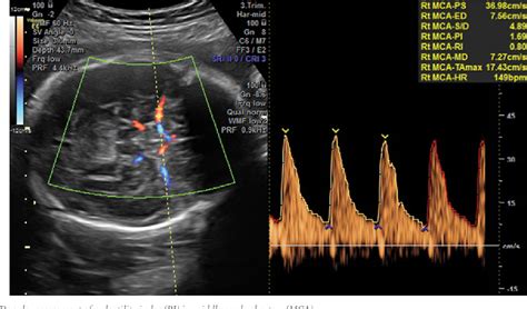 Middle Cerebral Artery Doppler